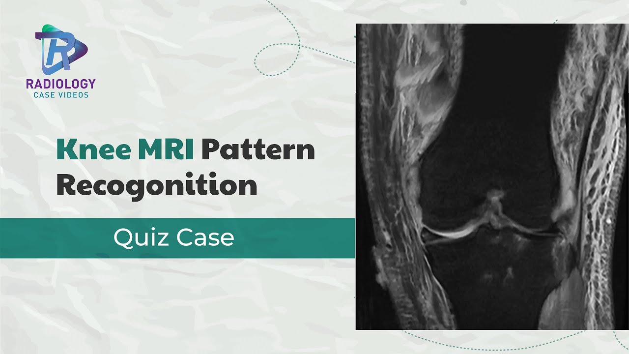 Knee MRI Pattern Recognition Quiz Case - YouTube