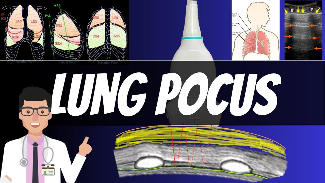 POINT OF CARE ULTRASOUND (POCUS) OF THE LUNGS - YouTube