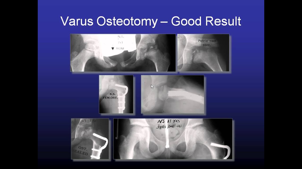 Evidence Based Treatments of Legg Calve Perthes Disease - YouTube