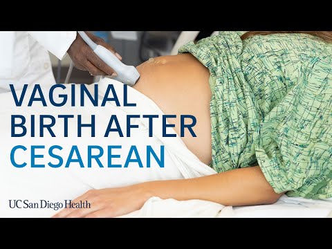 Giving Birth After a C-Section