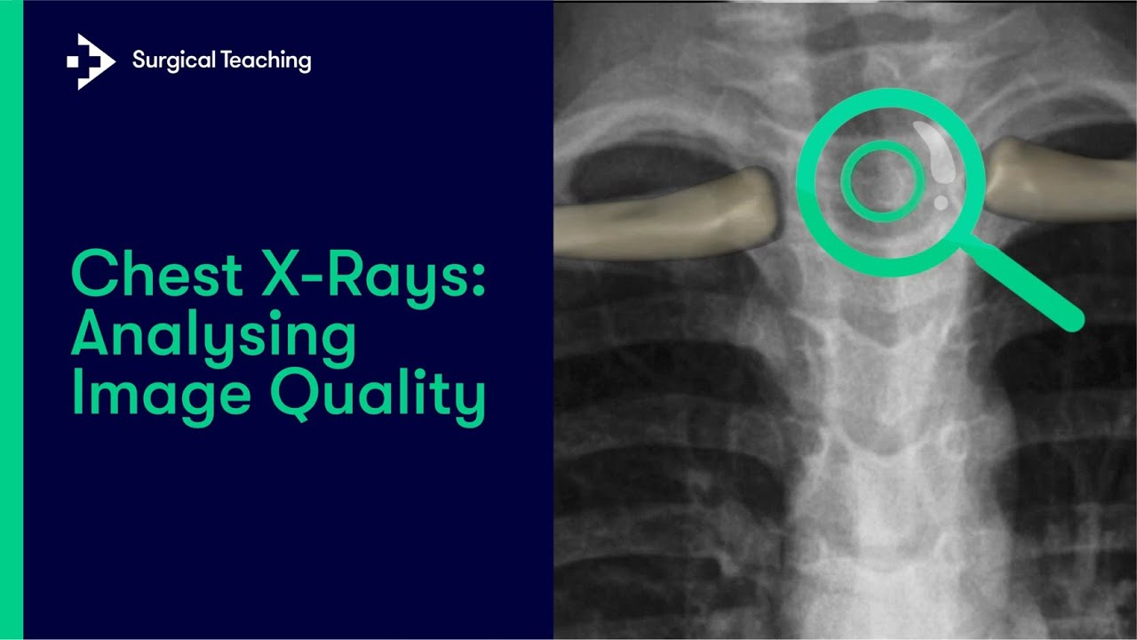 Chest X-Rays: Analysing Image Quality - YouTube
