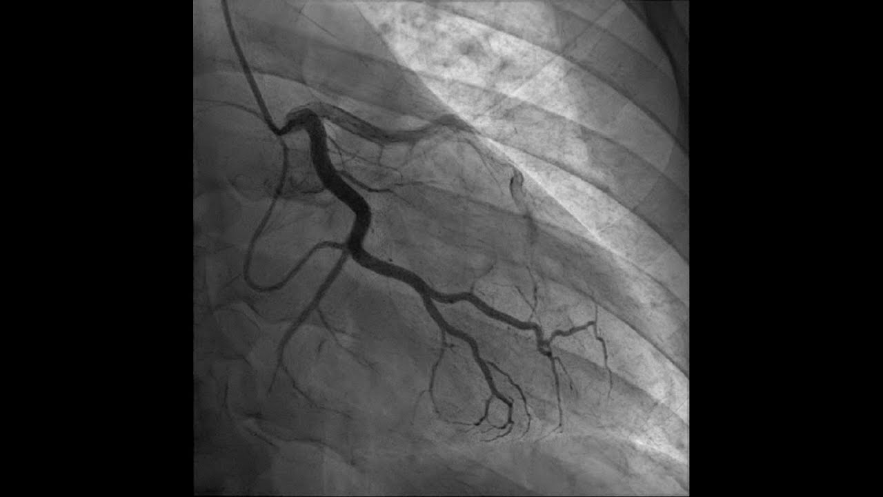 Coronarografie artera circumflexă || Dr. Pretorian - YouTube