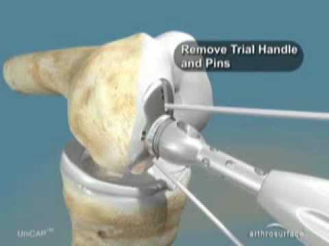 Arthrosurface Knee Part 2 - YouTube
