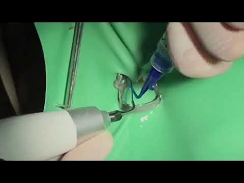 proses penambalan gigi geraham - YouTube