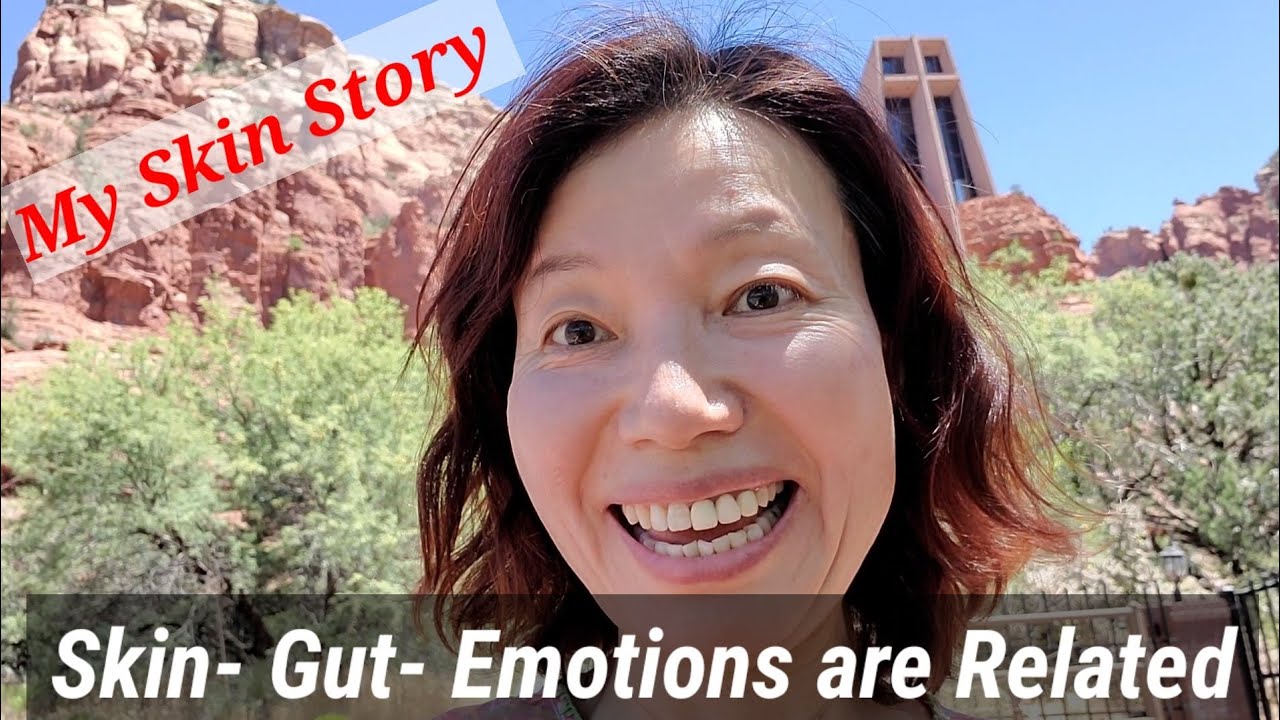 My Skin Story How I Cleared My Skin Naturally Youtube