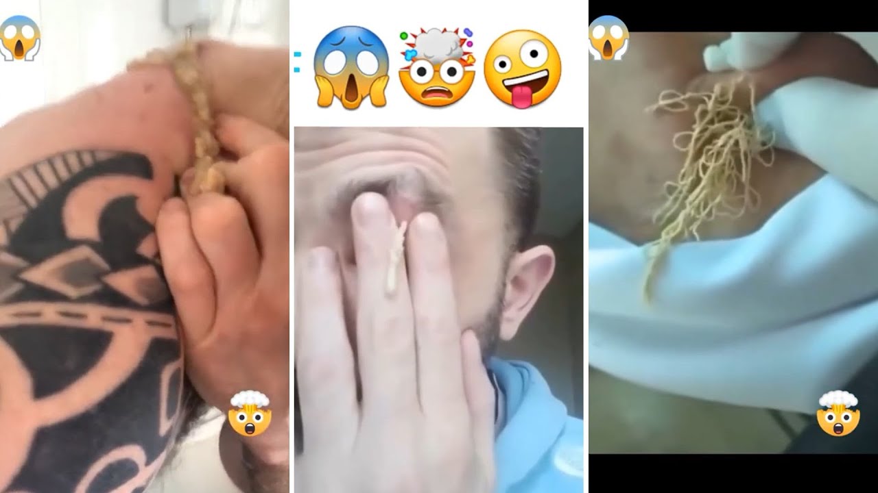 Best Satisfying Pimples Popping Cyst Removal Acne Blackheads ...