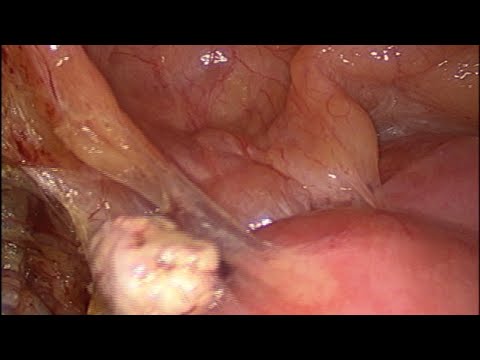 Complex hysterectomy