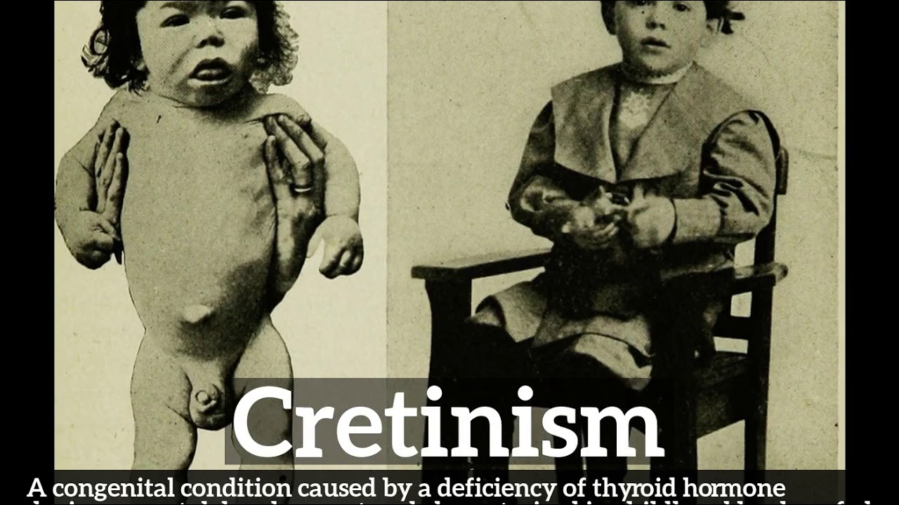 How to Say Cretinism in English? | How Does Cretinism Look? | What is ...