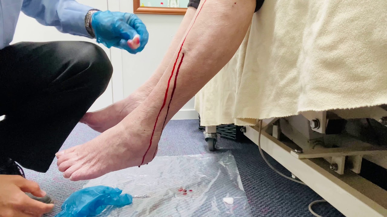 TCM Blood letting to treat toxin in blood for high blood pressure and ...