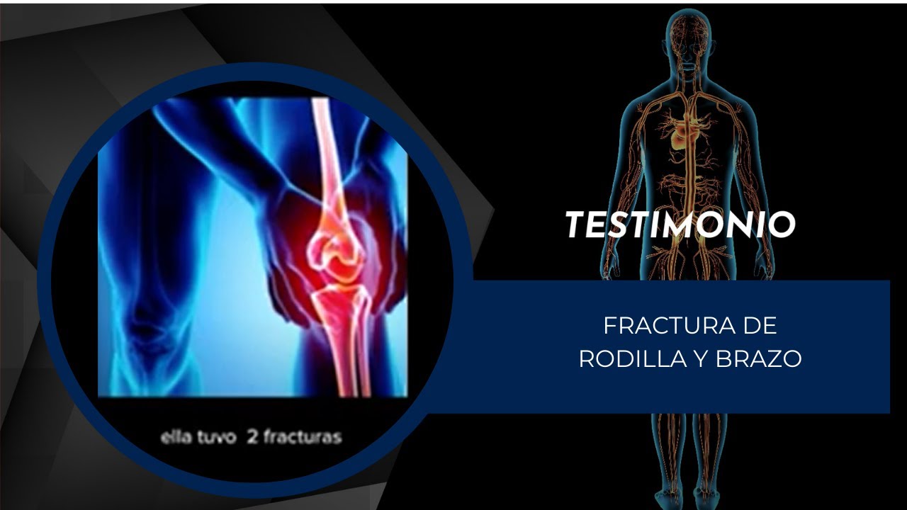 Testimonio fractura en la rodilla y brazo con la Tecnología de Células ...