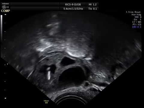 Oocyte retrieval with the Sense needle - YouTube