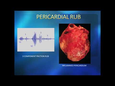 pericardial friction rub - YouTube