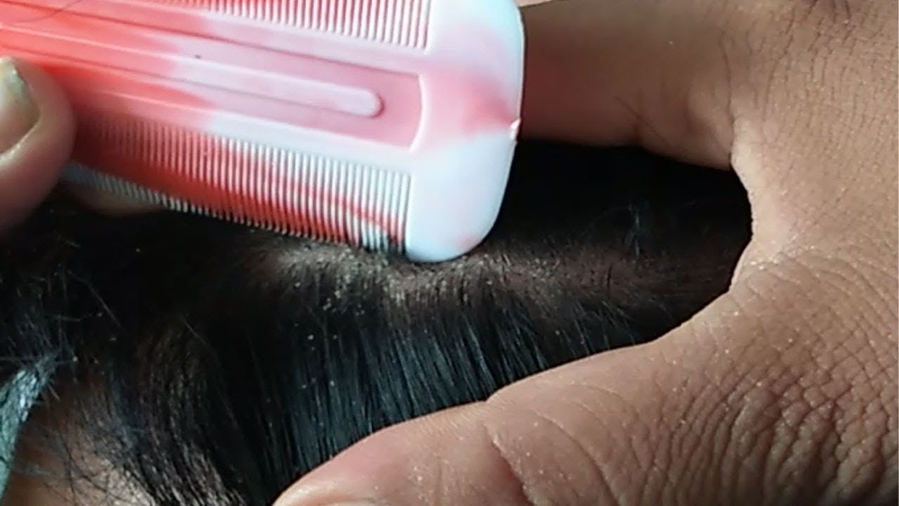 Dandruff/Extreme Dandruff Scratching / Extreme Flakes / Removing Big ...