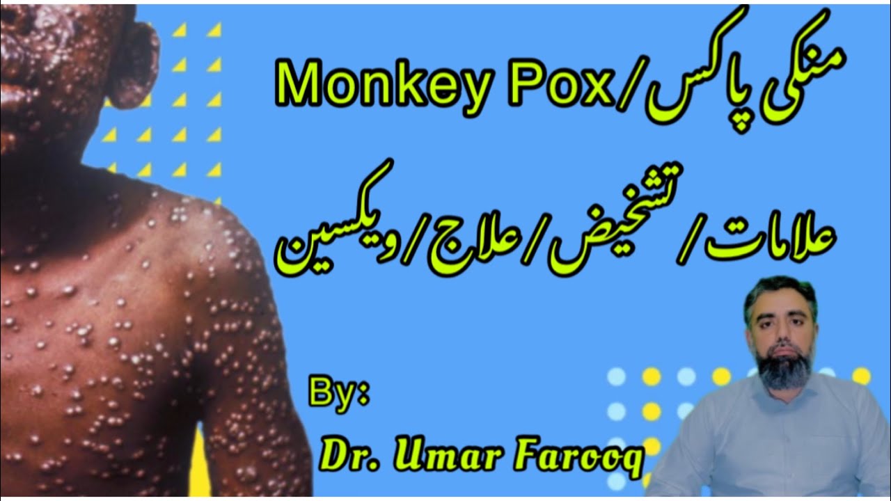 Monkey Pox | منکی پاکس | By: Dr. Umar Farooq - YouTube
