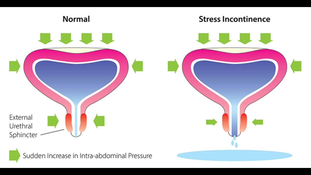 Stress Incontinence (Urine Incontinence); Definition, Characteristics ...