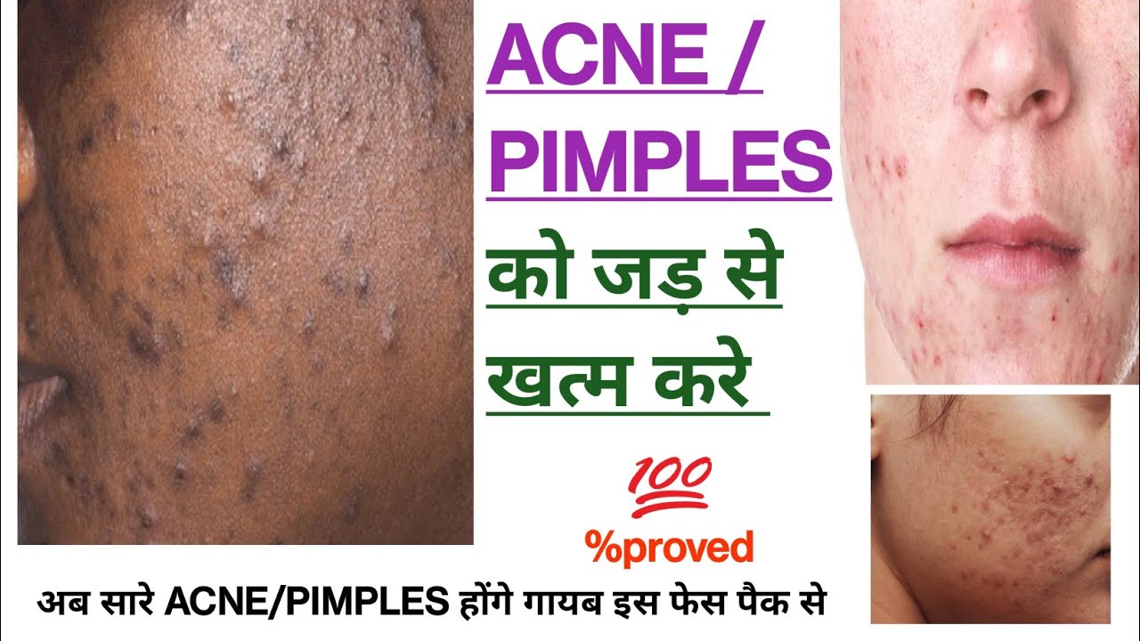 Acne Pimples Removal Facfack ll ACNE PIMPLES Ko Ghar Pr Kaise Remove ...