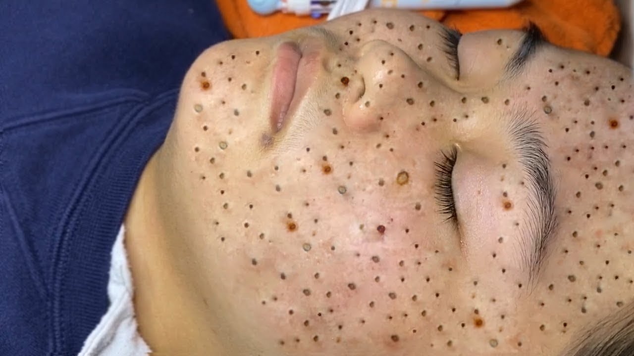 A Wonderful Day #10 - keratin plug blackhead keratin plug removal ...