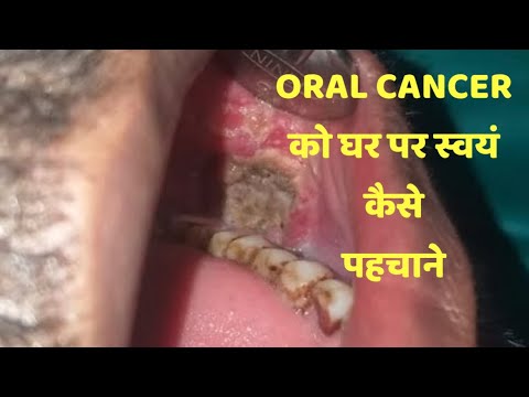 ORAL CANCER SELF SCREENING AT HOME TECHNIQUE #dentalcare #medical # ...