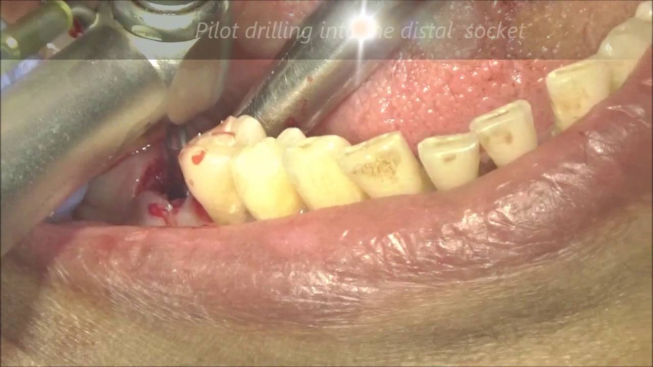 Severe periapical infected molar extraction and immediate IMPLANTOLOGY ...