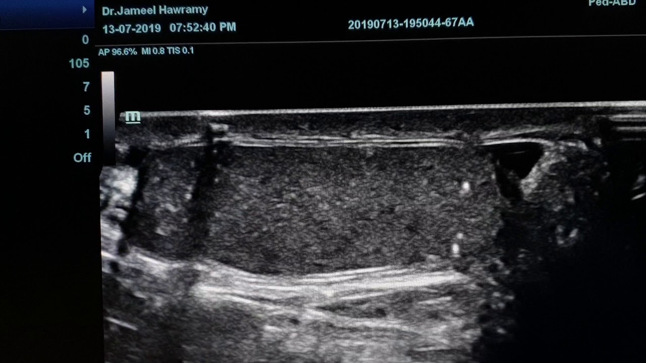 Testicular Microlithiasis Youtube