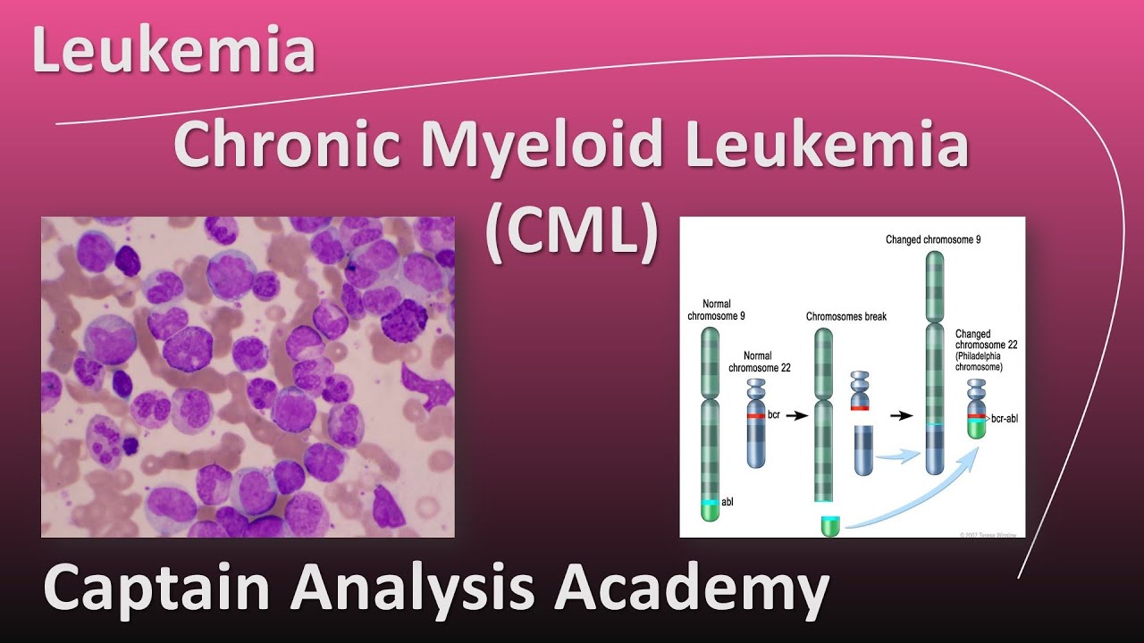 E5. Chronic myeloid leukemia (CML) Philadelphia chromosome سرطان الدم ...
