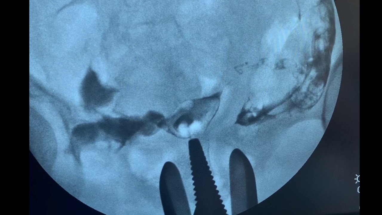 Hysterosalpingogram (HSG) - YouTube