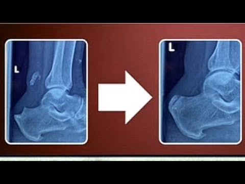 Calcaneal Tuberosity Avulsion Fracture & Achilles Tendon Avulsion ...
