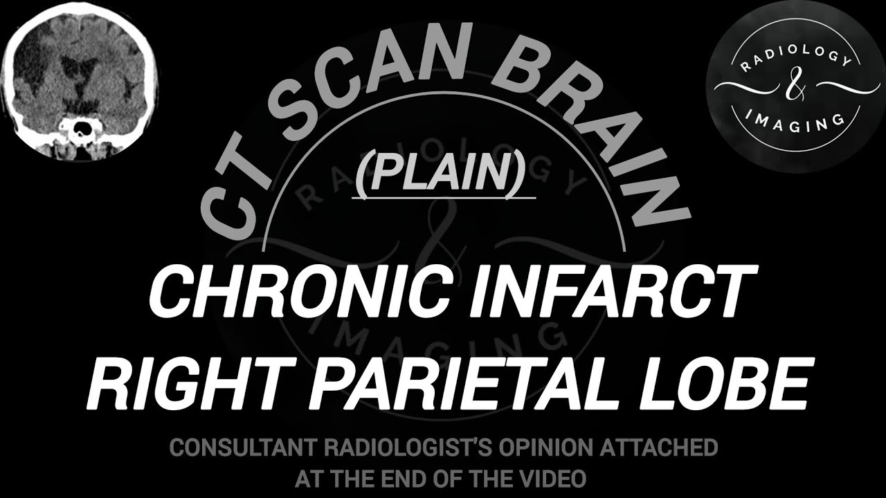 CT Scan Brain Plain - YouTube