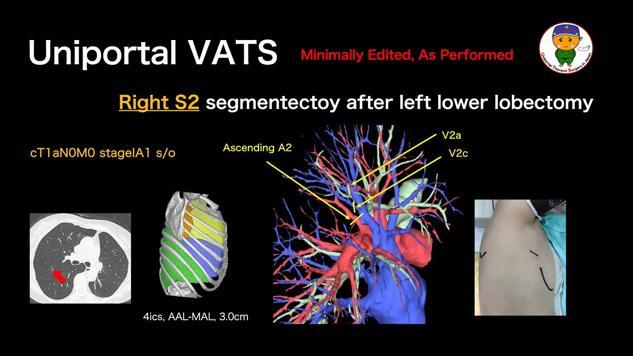 159】Uniportal VATS right S2 segmentectomy after LLL - Minimally Edited ...