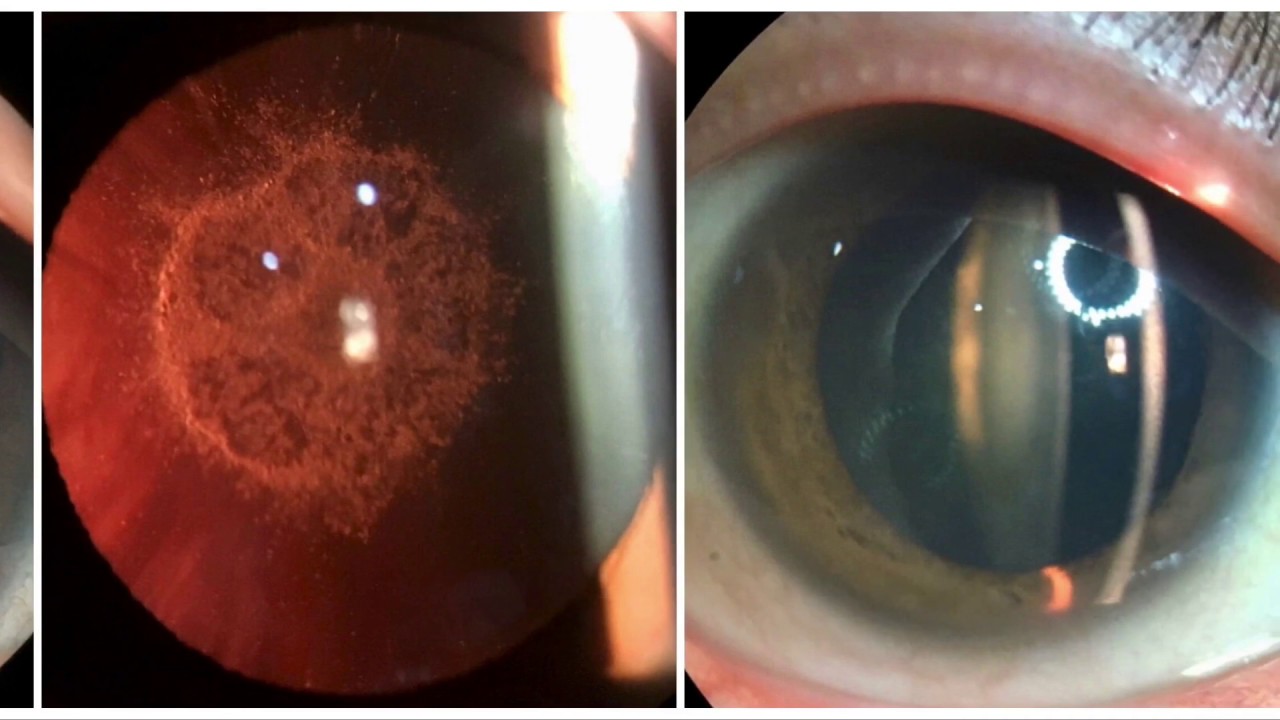 Phacoemulsification with Multifocal IOL in a Diabetic Patient with ...
