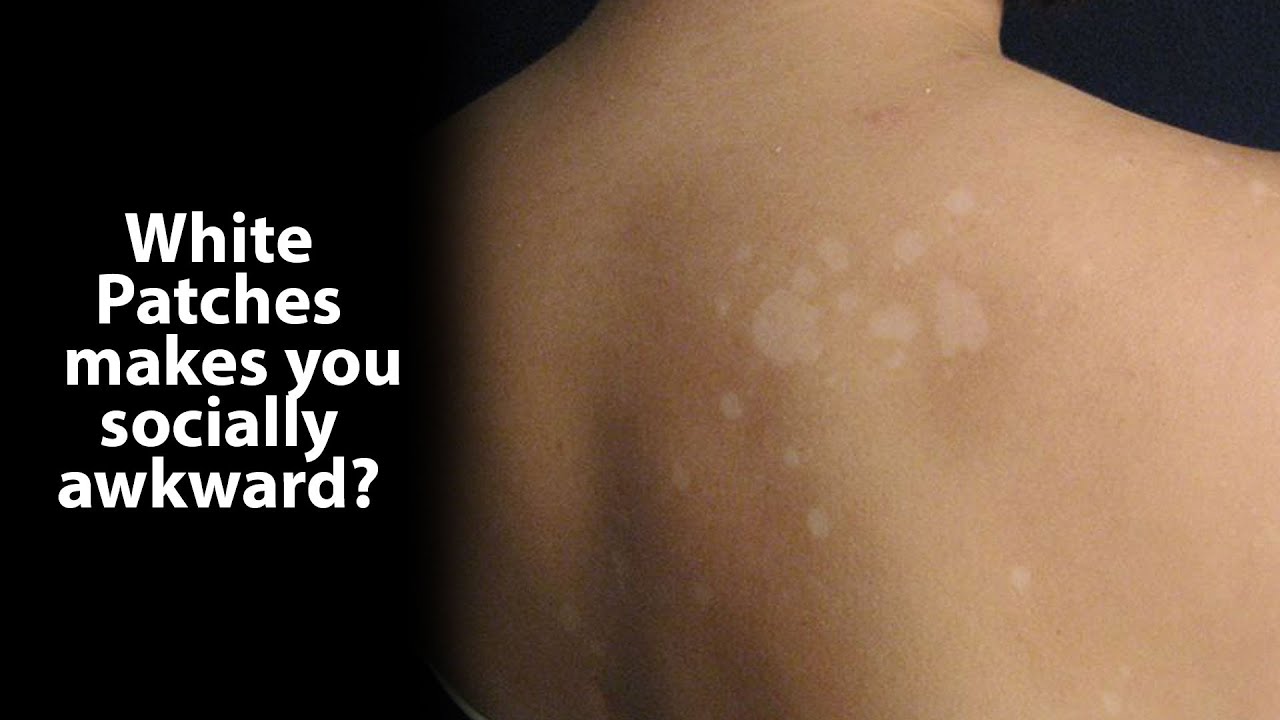 White Patches makes you socially awkward? - YouTube