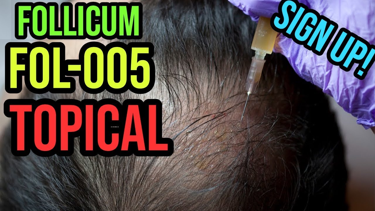 FOLLICUM FOL-005 TOPICAL HUMAN TRIAL UPDATE! - YouTube