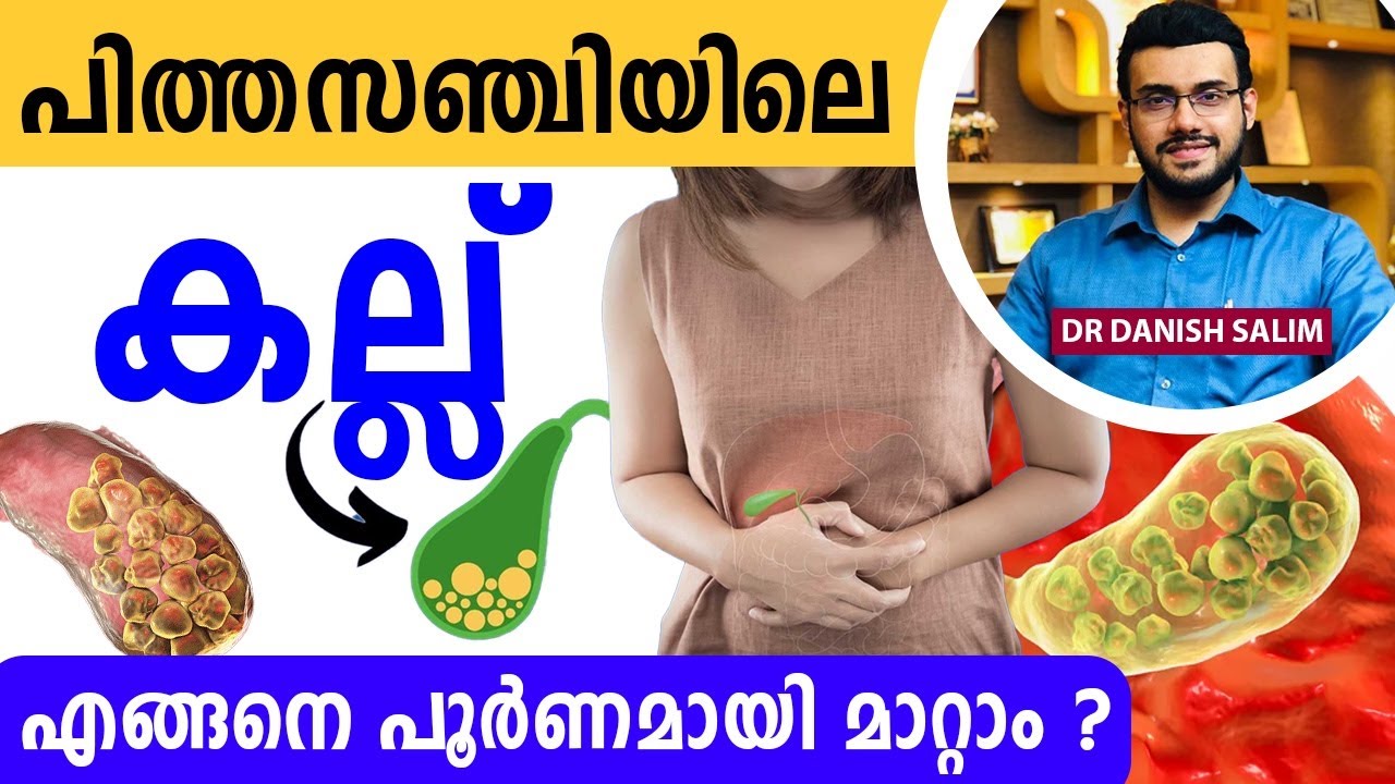 പിത്തസഞ്ചിയിൽ കല്ലുള്ളവർക്ക് എന്ത് ചികിത്സയാണ് എടുക്കേണ്ടത് ? Treatment ...