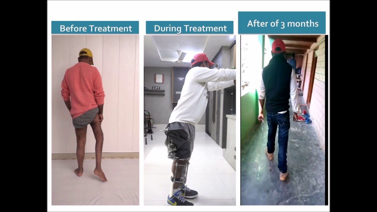 Polio treatment -Post Polio Syndrome- Hand Thigh gait ,Treated with ...