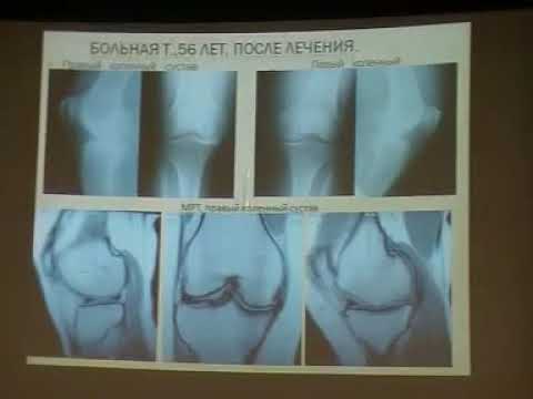 Неоколлаген Артро от компании Арт Лайф - YouTube