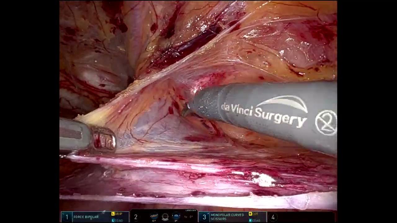 Robotic Bilateral inguinal hernia repair with mesh - YouTube