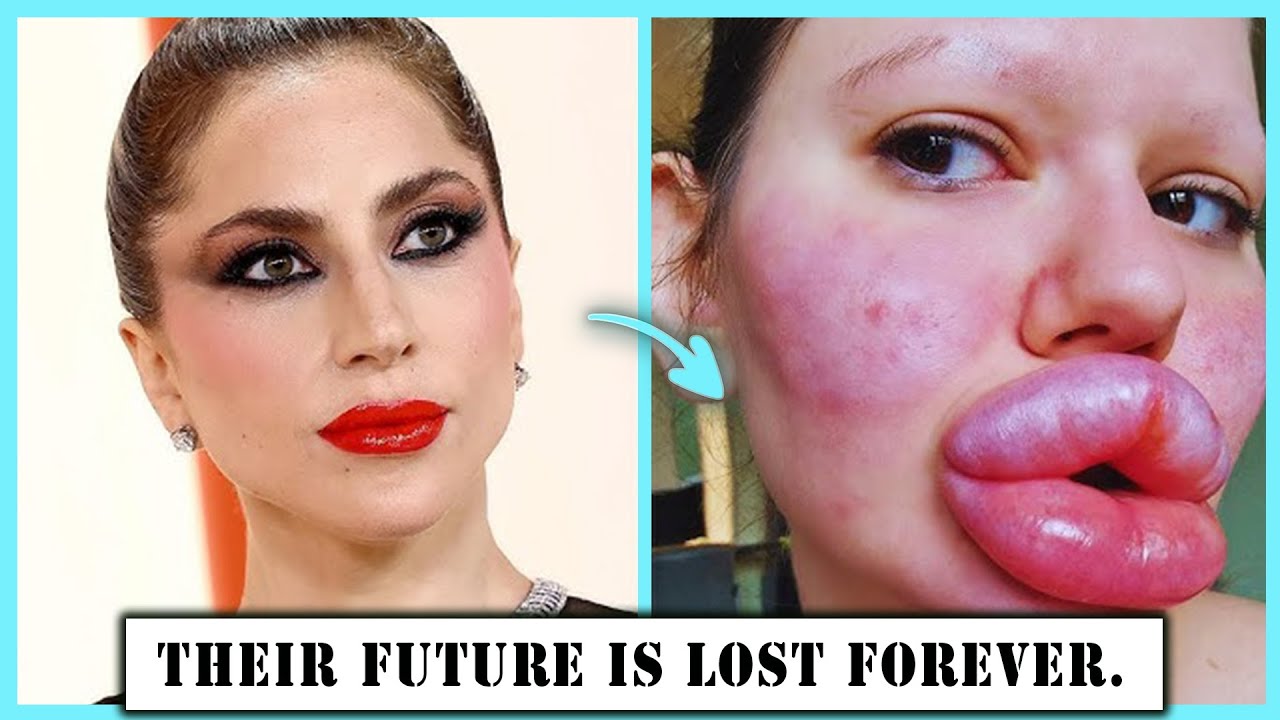 14 Celebrity Plastic Surgery Disasters Full Album | Then and Now 2025 ...