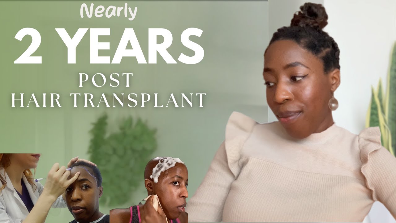 Quick Hair Transplant Update- Heva Clinic, Starting locs, DIY hair ...