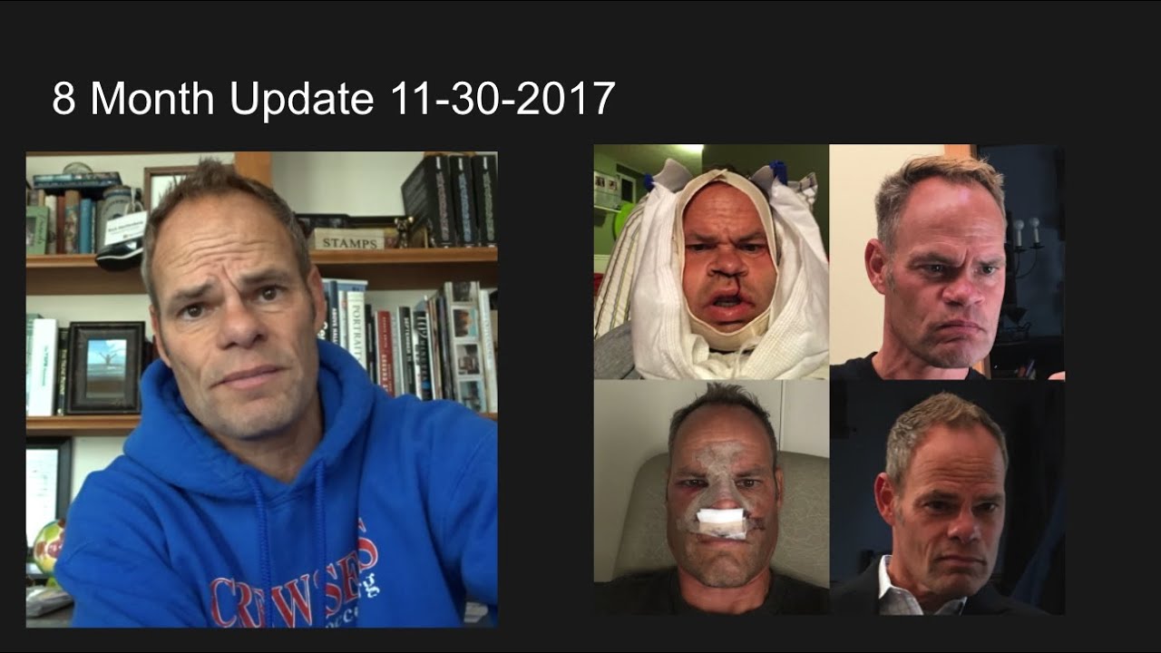 Double Jaw Surgery - Sleep Apnea - 8 Months - YouTube