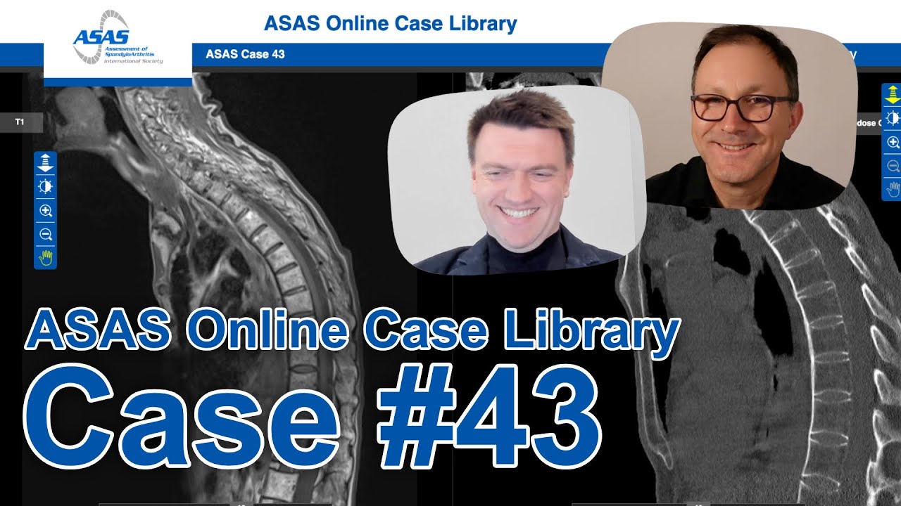 Case 43 of the ASAS Online Case Library // Bamboo Spine - YouTube