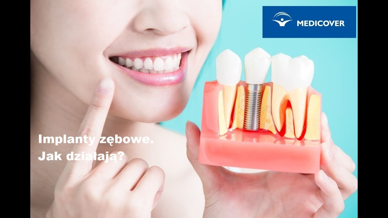 Implanty zębowe. Jak działają? - YouTube