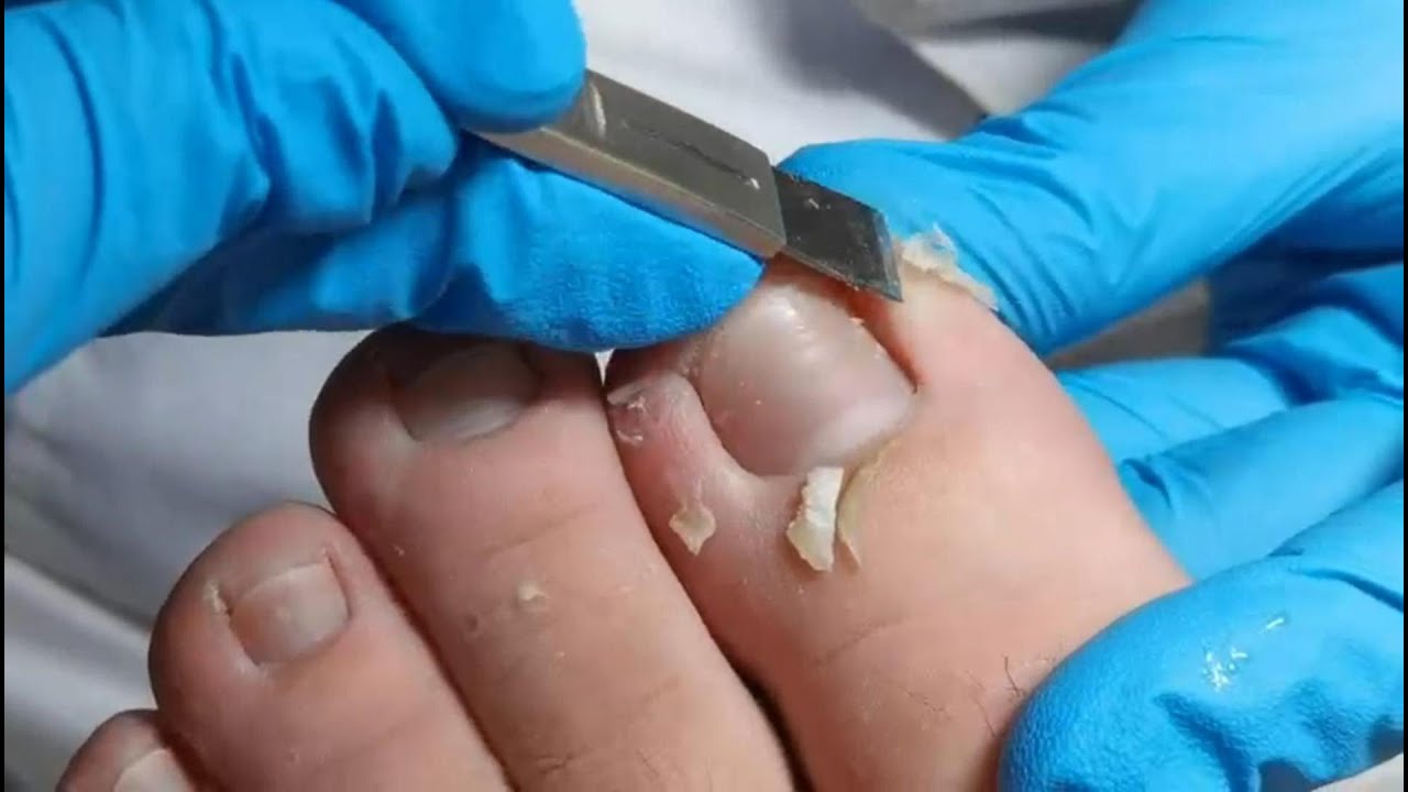 Remove nails without pain. Fungal nail treatment & ingrown toenails ...