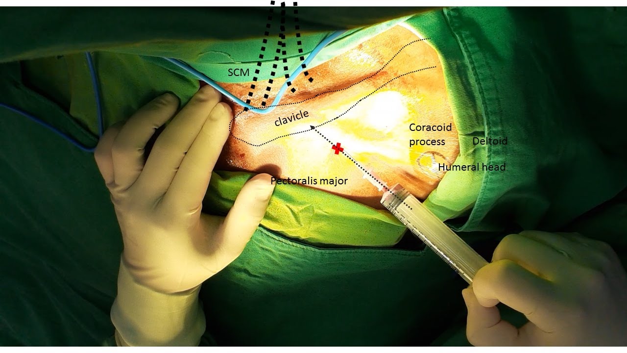 Implanted venous access device (Port-a) implantation, left subclavian ...