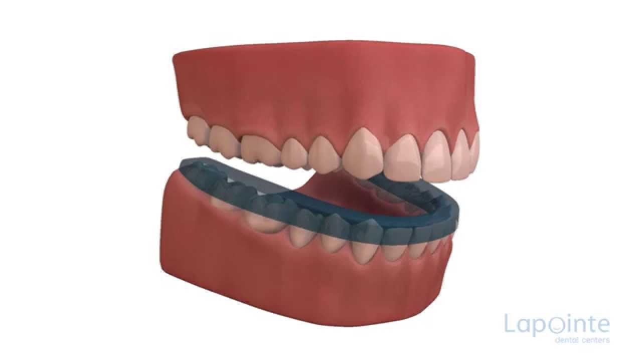 Abfraction and abrasion - Lapointe dental centres - YouTube