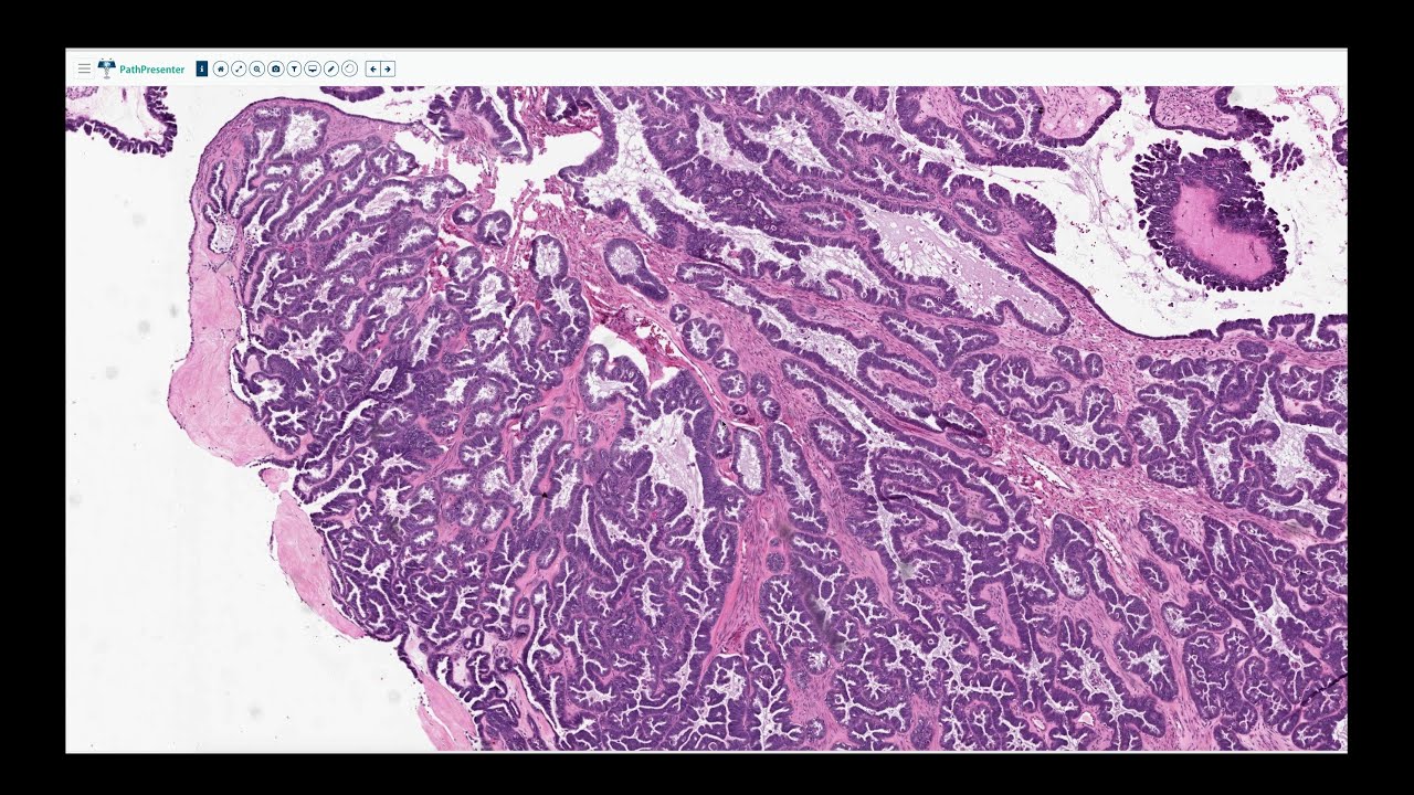 Epithelial Ovarian Tumors Digital Slide Review - YouTube