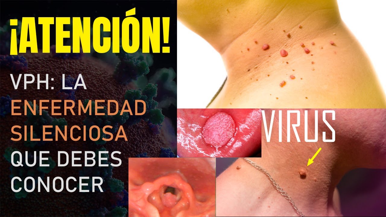 ¡Las consecuencias peligrosas del VPH para aquellos con VIH y ...