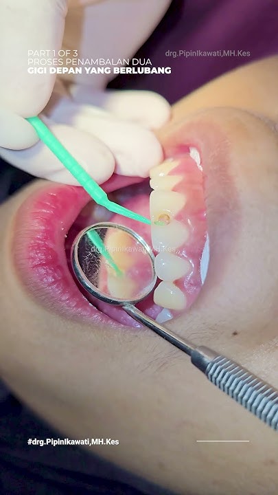 PROSES PENAMBALAN DUA GIGI DEPAN YANG BERLUBANG || PART 1 OF 3 - YouTube
