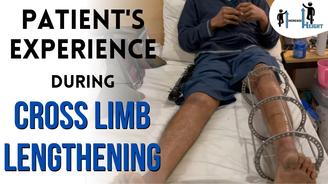 Cross #Limb #Lengthening Patient Experience with Team Height Increase ...