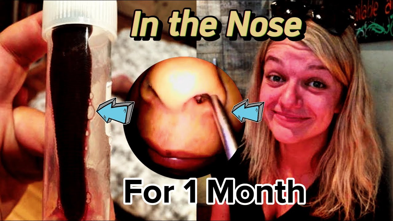 Parasite TRUE Scary & Disturbing Horror Stories (True Scary Stories ...