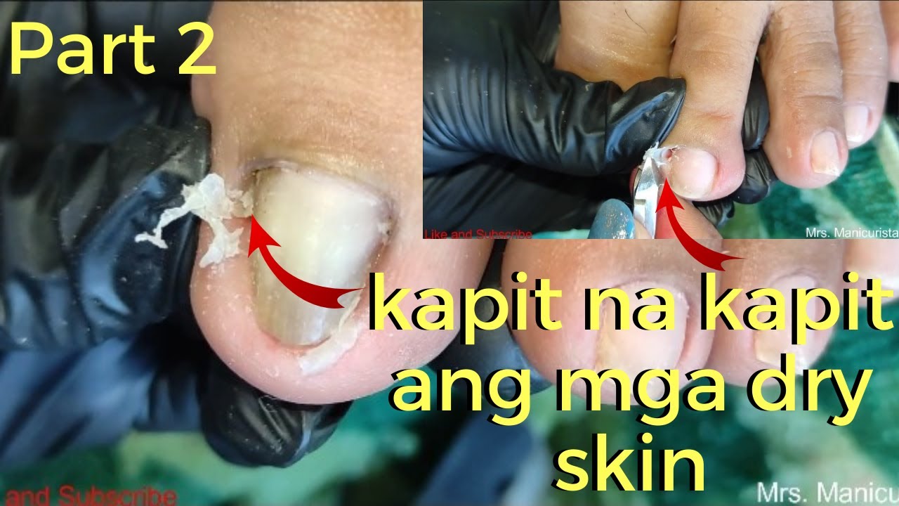 Vlog 626|Dry Skin/Ingrown Removal| PEDICURE 526 - YouTube